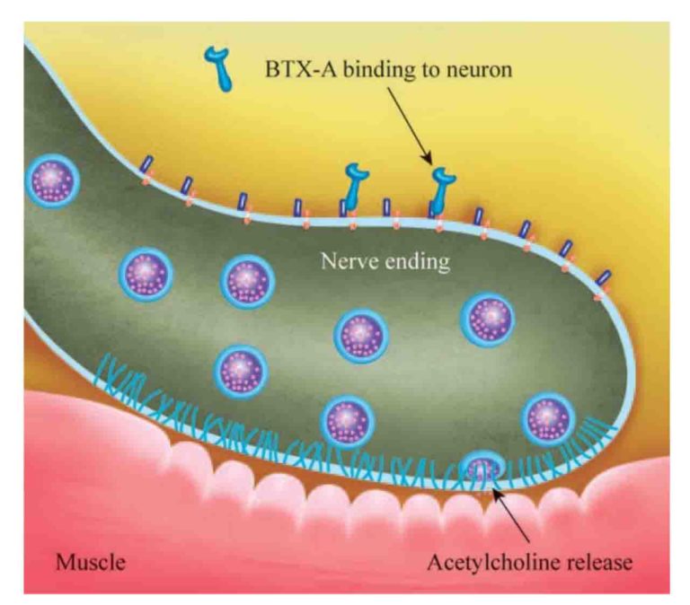 Unit 4: Introduction To Botulinum Toxin & Mechanism Of Action – Vindoc ...